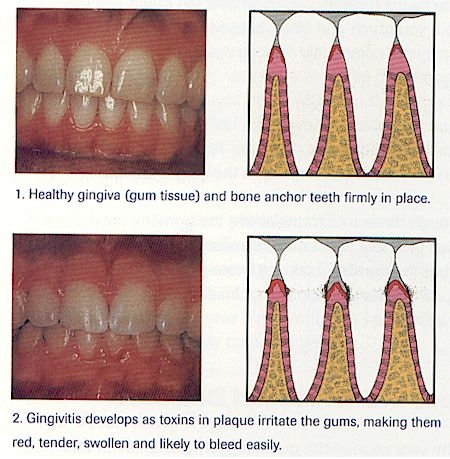 Gingivitis